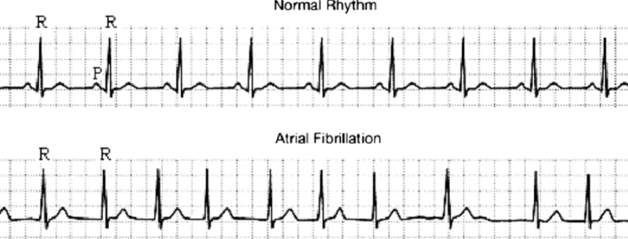 What Causes Atrial Fibrillation?